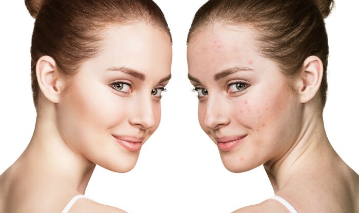 How to get rid of acne? 19 tips to get back your acne-free glowing and ...