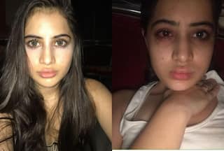 Lip Fillers : Latest News, Videos and Photos on Lip Fillers - India.Com ...
