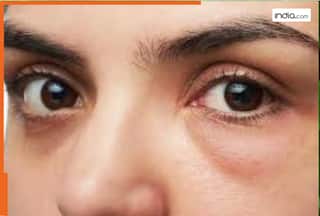 Swollen Eyelid News in Hindi, Latest Swollen Eyelid News | India.Com News