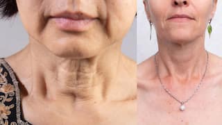 Neck Sagging Skin News in Hindi, Latest Neck Sagging Skin News | India ...